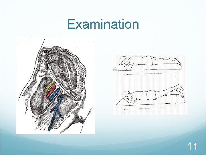 Iliopsoas Abscesses Jeremy Lynch 1 Case 66 year