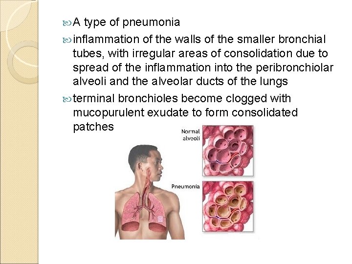 Bronchopneumonia A type of pneumonia inflammation of the