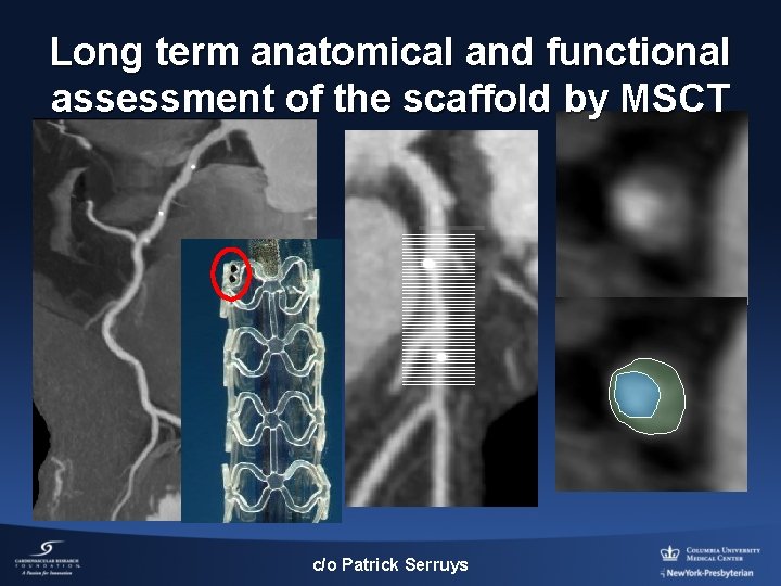 The Promise of ABSORB Bioabsorbable Vascular Scaffolds Gregg
