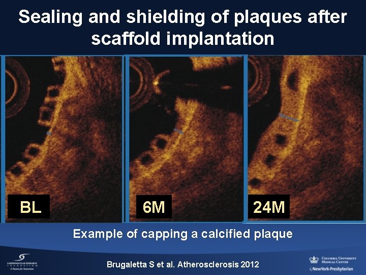 The Promise of ABSORB Bioabsorbable Vascular Scaffolds Gregg