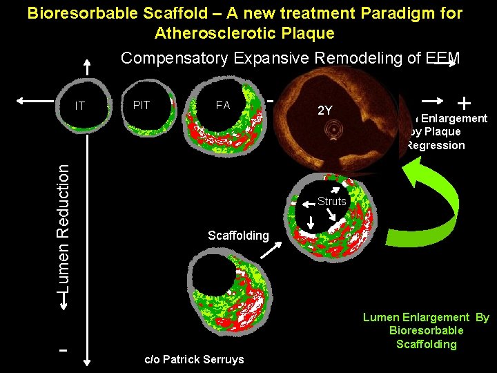 The Promise of ABSORB Bioabsorbable Vascular Scaffolds Gregg