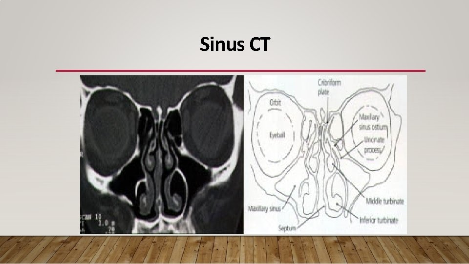CHRONIC SINUSITIS AND MANAGEMENT Dr Nayana V G