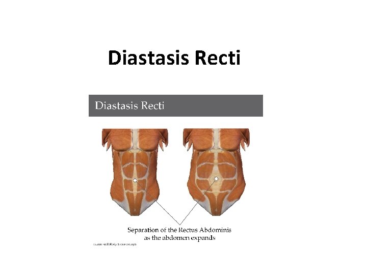 Diastasis Recti THE ABDOMINAL MUSCLES The anterior and