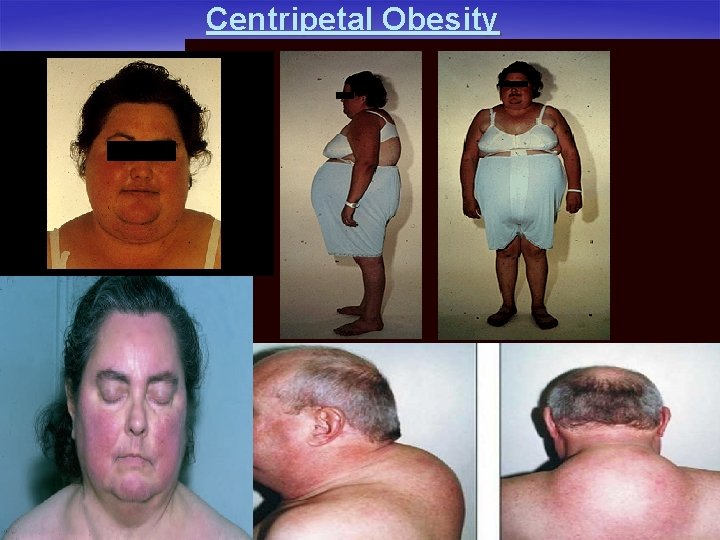 SYNDROME DE CUSHING 06112018 HMRUC ENDOCRINOLOGIE Dr A