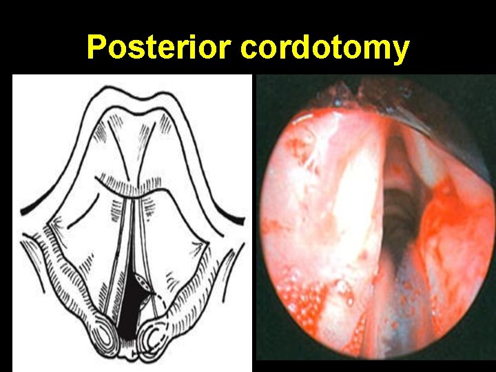 Congenital Larynx Lesions Stridor Evaluation Dr Vishal Sharma