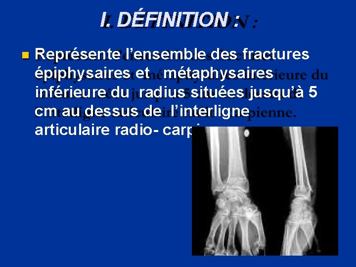 Fractures de lextrmit infrieure du radius I DFINITION