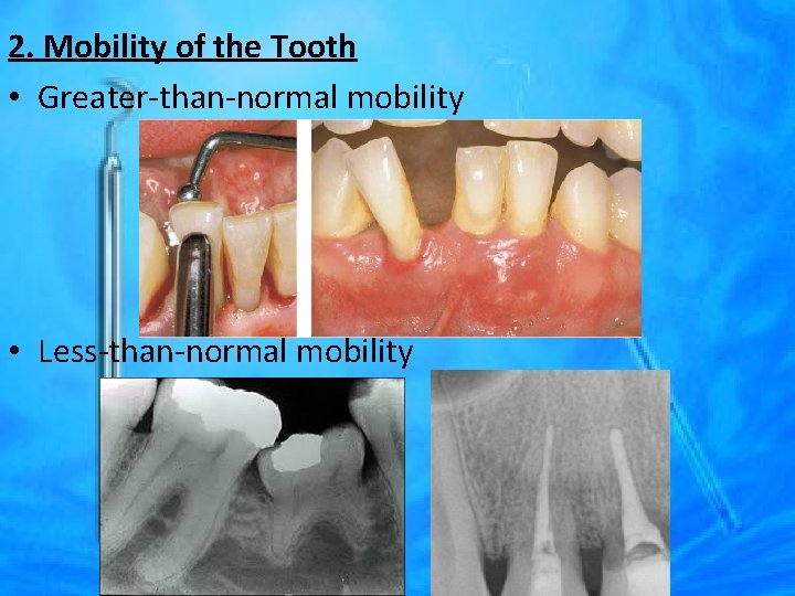 Tooth Extraction Exodontia Definition Methods of extraction Intraalveolar