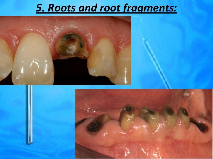 Tooth Extraction Exodontia Definition Methods of extraction Intraalveolar