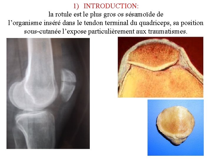 Les Fractures de la Rotule Professeur KANDJERA Lamine