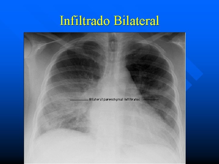 Infeces Agudas do Trato Respiratrio Caio Nunes Introduo