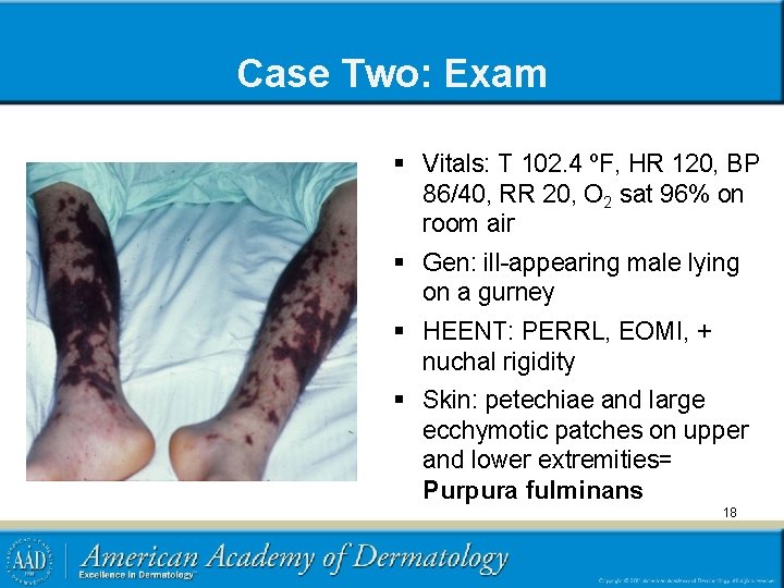 Petechiae Purpura and Vasculitis Basic Dermatology Curriculum Last
