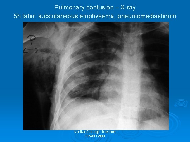 Thoracic injuries 1 2 3 Incidence 10mortality 25