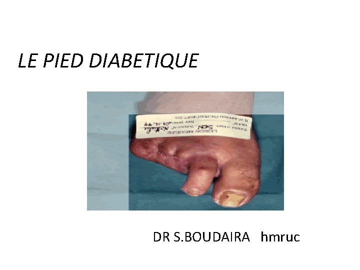 LE PIED DIABETIQUE DR S BOUDAIRA hmruc PLAN