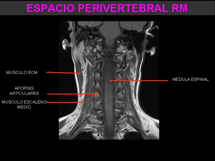 ESPACIO PERIVERTEBRAL DEFINICIN Espacio con morfologa cilndrica que