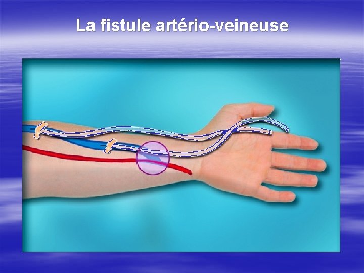 HEMODIALYSE Dr R Milongo AGDUC CHU de Grenoble