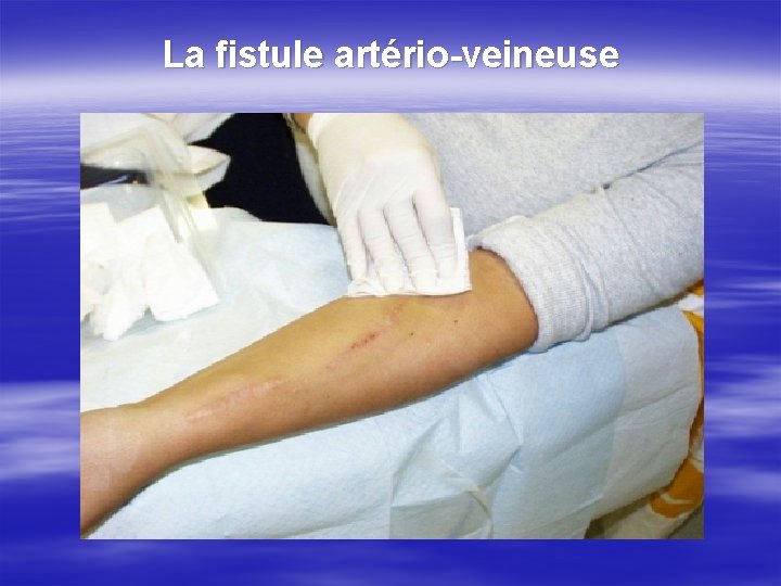 HEMODIALYSE Dr R Milongo AGDUC CHU de Grenoble