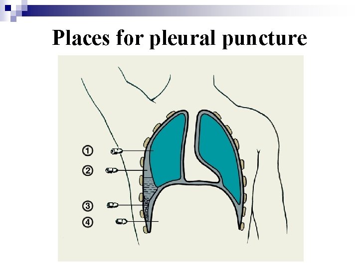 Purulentinflammatory diseases of the lung and pleura Injury