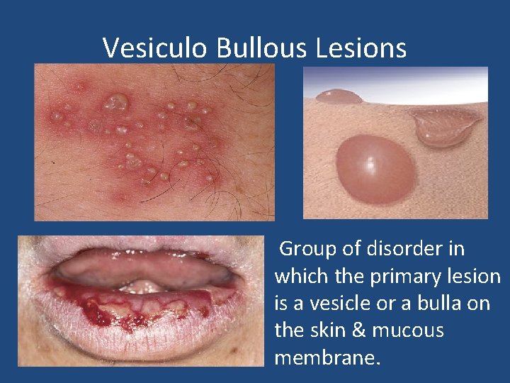 Good Morning Vesiculo Bullous Lesions Group of disorder