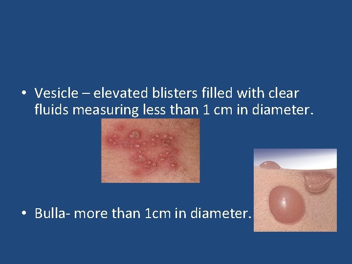 Good Morning Vesiculo Bullous Lesions Group of disorder