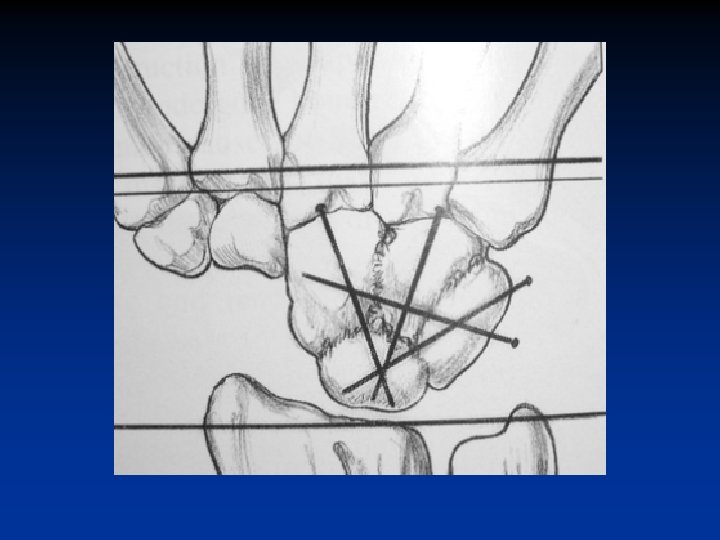 SLAC SNAC wrists Management Results Satyam Patel January