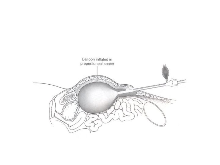 INGUINAL HERNIA REPAIR OPEN vs TEP APPROACHES Prof