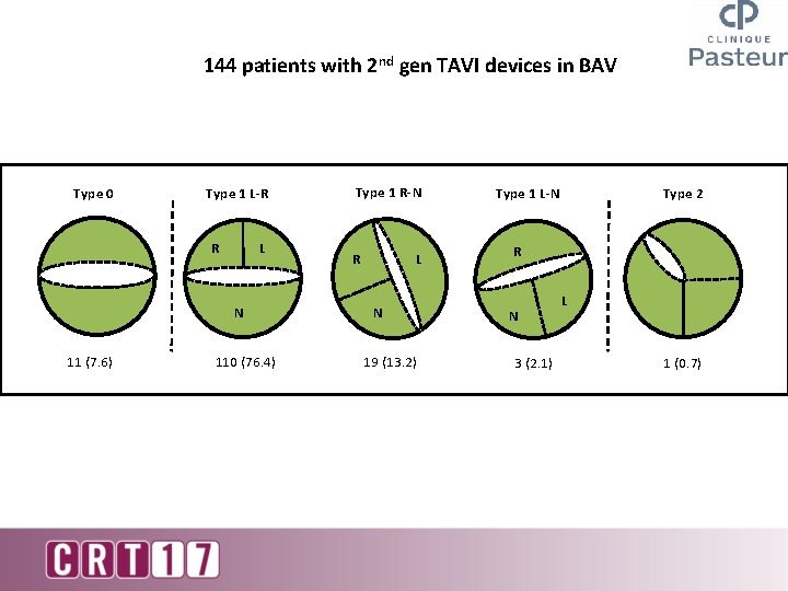 Second Generation TAVR devices for Bicuspid Disease Outcomes