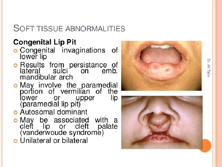Developmental Defects of the Lip and Palate OROFACIAL