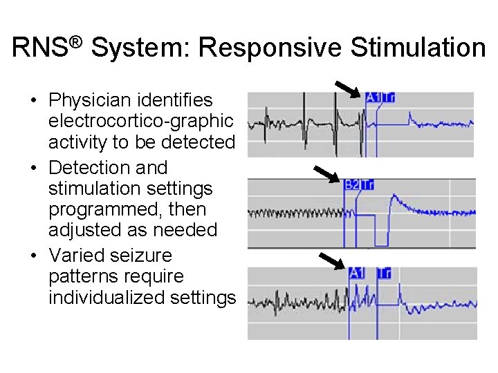 Responsive Neurostimulation RNS for the treatment of epilepsy