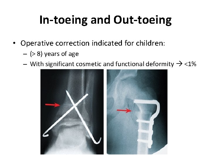 Common Pediatric Lower Limb Disorders Dr Khalid Bakarman