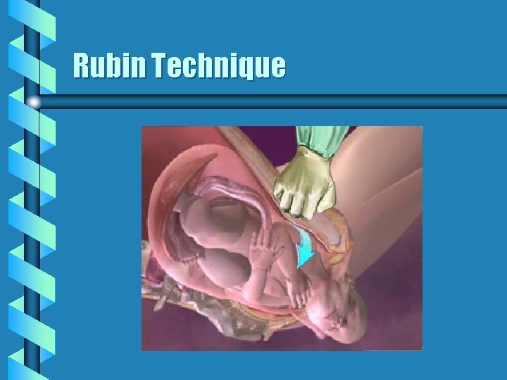 Shoulder Dystocia Making the Best of a Bad