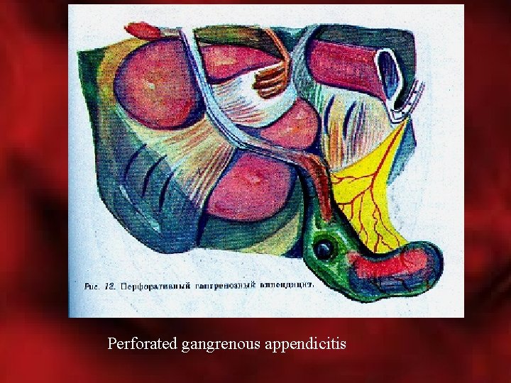 Acute abdomen Department of surgical diseases for general