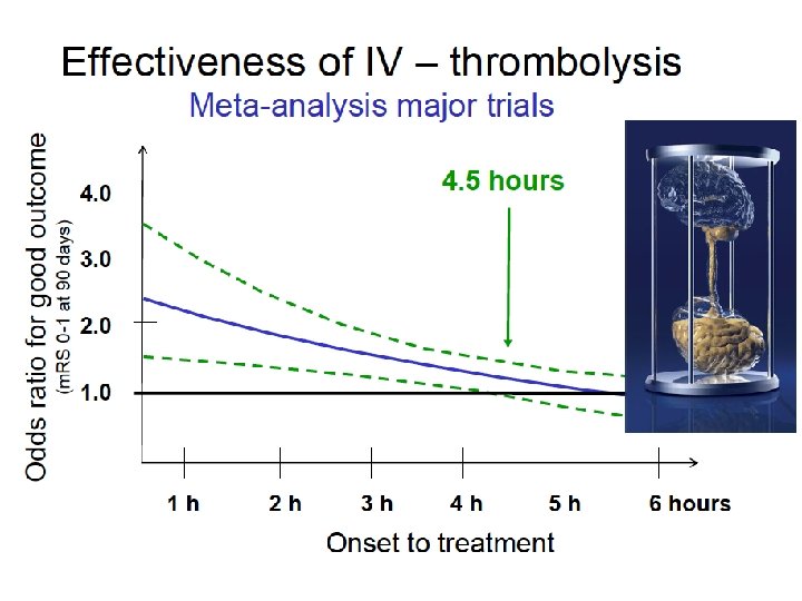 Time is Brain Tissue Ischaemic core brain tissue