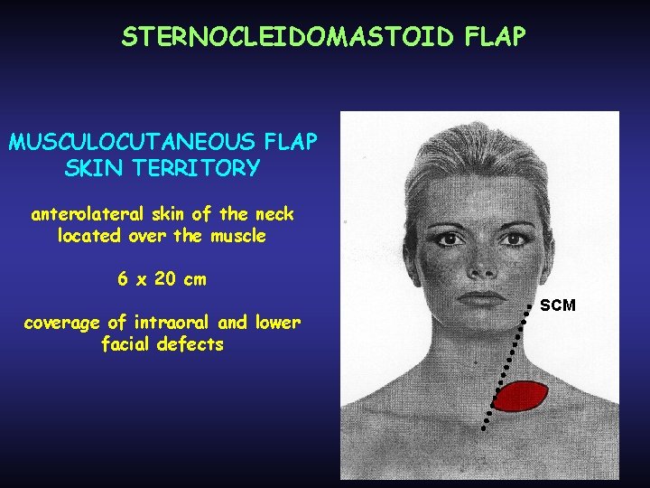 STERNOCLEIDOMASTOID FLAP FEATURES Lateral and oblique in the