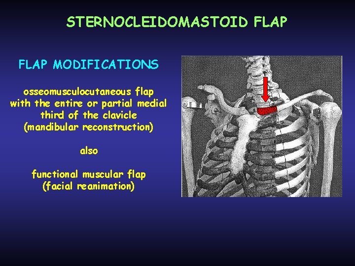 STERNOCLEIDOMASTOID FLAP FEATURES Lateral and oblique in the