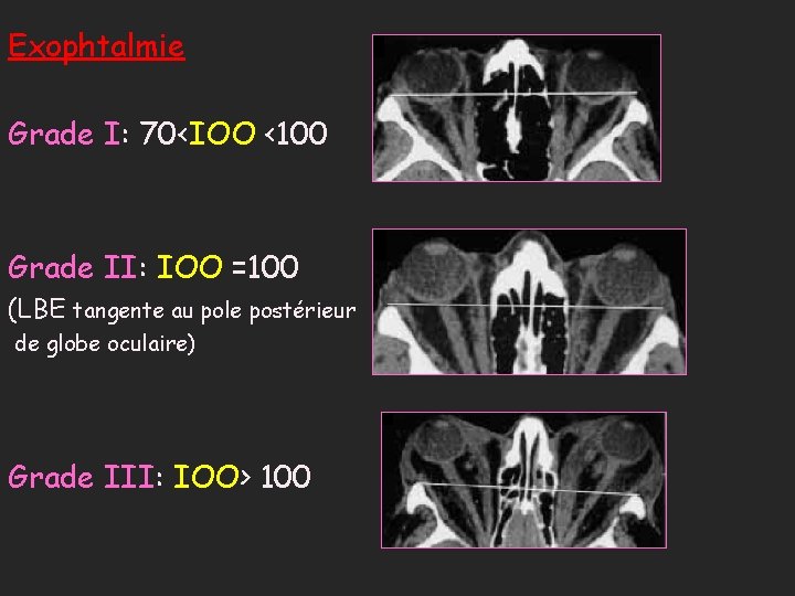 Les exophtalmies PLAN INTRODUCTION CLINIQUE MOYENS DIMAGERIE ETIOLOGIES