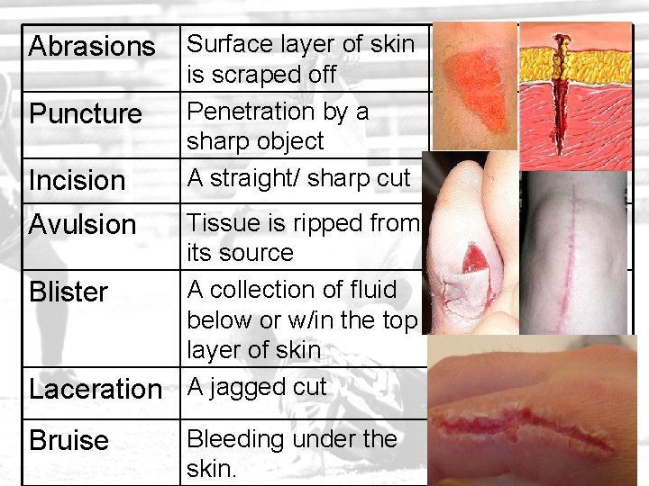 Mechanisms and Characteristics of Sports Trauma How Injuries