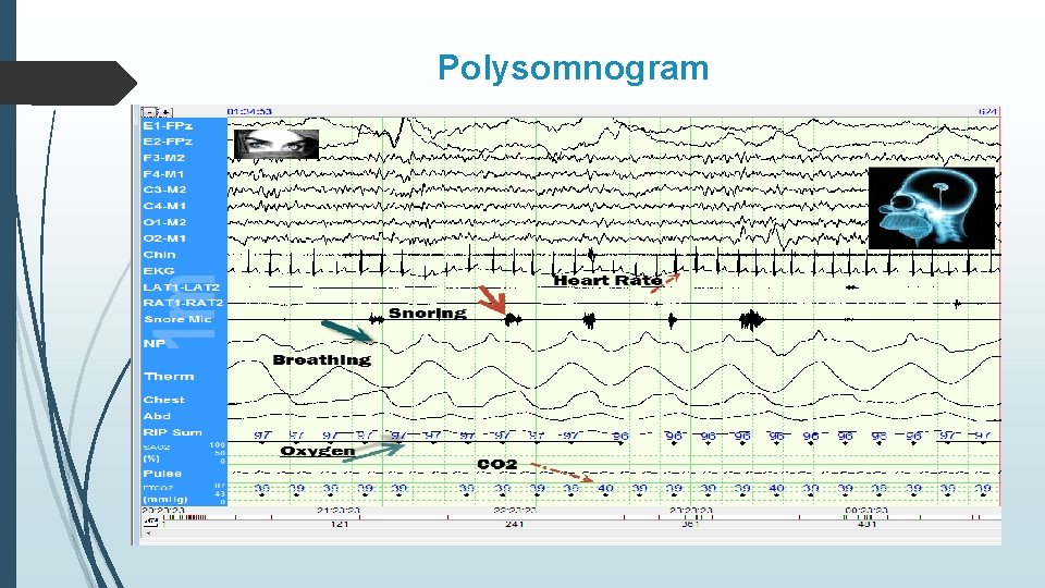 Obstructive Sleep Apnea Poor bedfellow Dessislava Ianakieva MD
