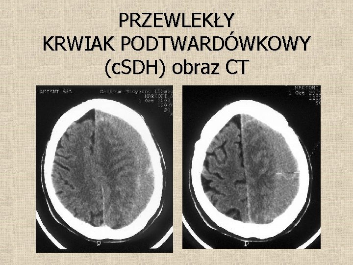 URAZY CZASZKOWOMZGOWE Dr med Piotr Bojarski KATEDRA I