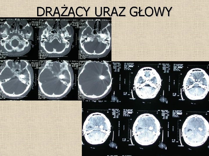 URAZY CZASZKOWOMZGOWE Dr med Piotr Bojarski KATEDRA I