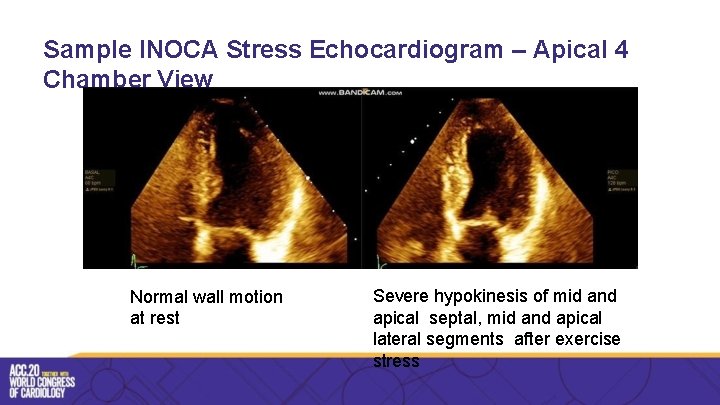 Natural History Of Symptoms And Stress Echo Findings