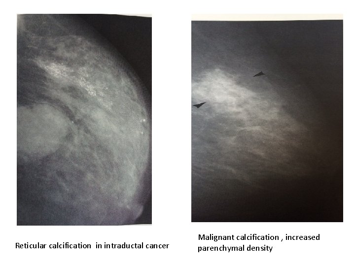 investigations of the breast lump Azra Tabassum Facts