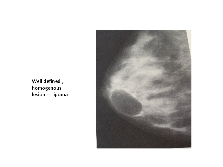 investigations of the breast lump Azra Tabassum Facts