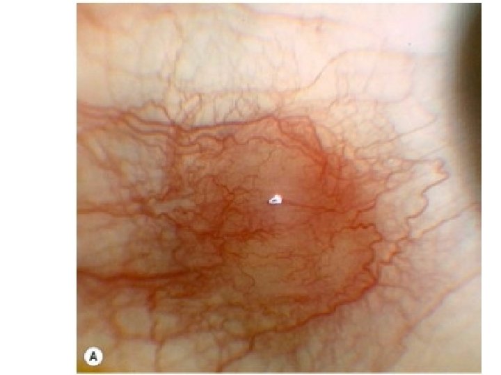 Scleritis and Episcleritis Dr Soujanya K MBBS MS