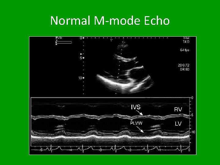 Nonischemic regional wall motion abnormality LBBB Dr sajeer