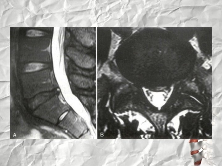 History Axial Referral Radicular Acute Subacute Chronic Red