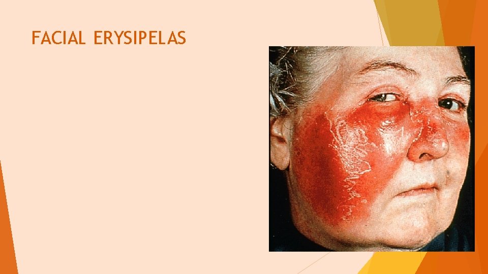 Bacterial skin infections Dr Mohammad Arif Abid Impetigo