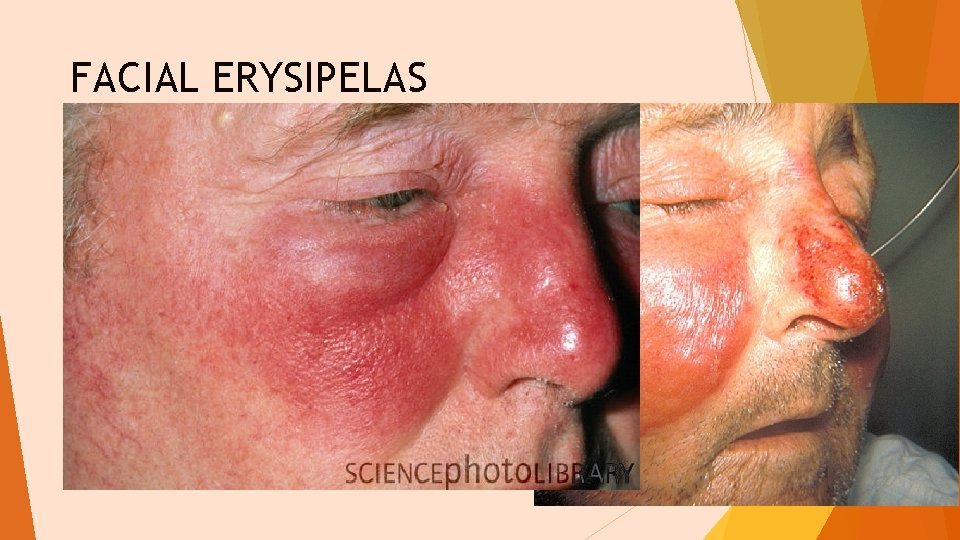 Bacterial skin infections Dr Mohammad Arif Abid Impetigo