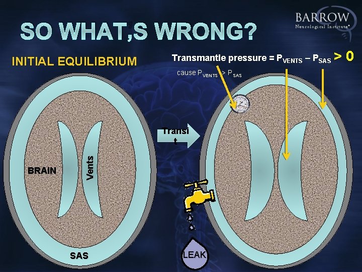 NEGATIVE PRESSURE HYDROCEPHALUS THE ROLE OF CSF LEAKS