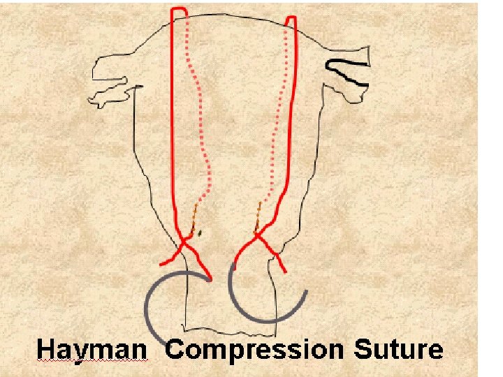 Intractable Postpartum hemorrhage About 10 of women will