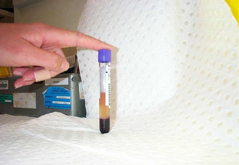 The diagnosis of HIV infection using antibody tests